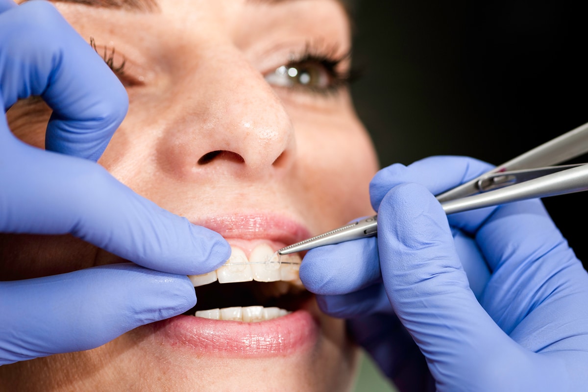 How Long Do Braces Take to Straighten Your Teeth? | Orthodontics