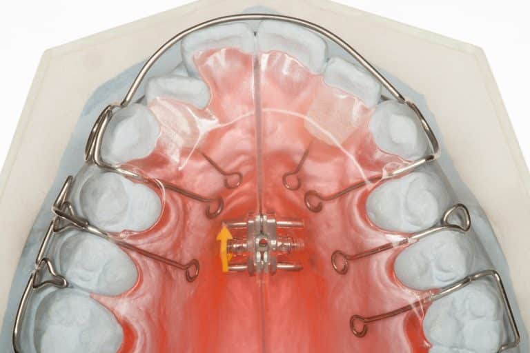How Palate Expanders Affect Facial Structure and Cheekbones - Hass ...